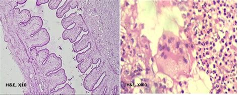 Lumpy Bumpy Cyst That Still Persists A Rare Case Of Cysticercosis Of Abdominal Wall