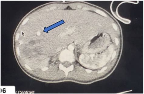 Arrow Depicts A Persistent 6 Mm Hepatic Pseudoaneurysm Download Scientific Diagram