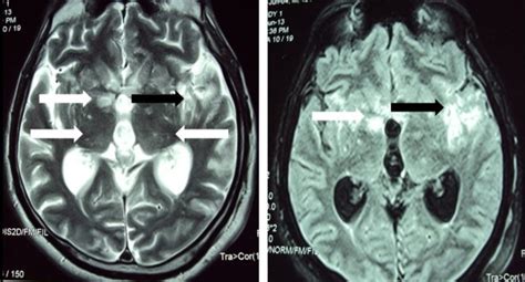 Cryptococcus Cryptococcosis Concise Medical Knowledge