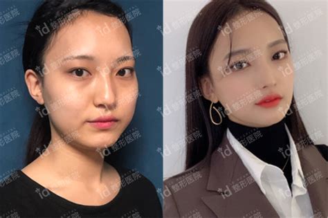 鼻综合 颧骨缩小 下巴缩小术 id整形医院