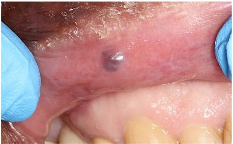 Fordyce Granules On Gums