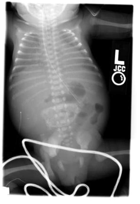 Meconium Peritonitis Radiology Case Radiology
