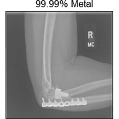 Sample Digital Radiographs Of Digital Radiographs With Metal And Download Scientific Diagram