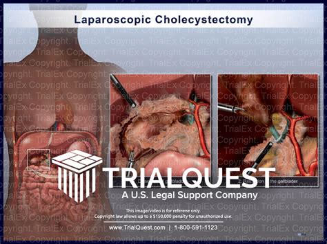 Laparoscopic Cholecystectomy Steps