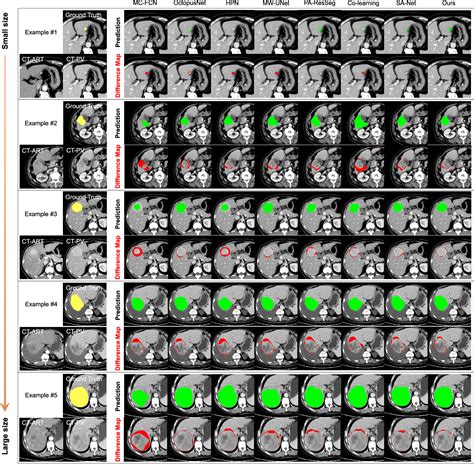 Figure 5 From Multi Modal Tumor Segmentation With Deformable