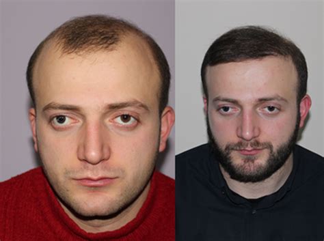 Hairline International