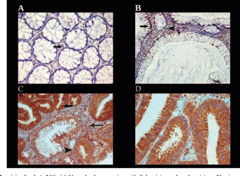 Large Bowel Juvenile Polyp Semantic Scholar