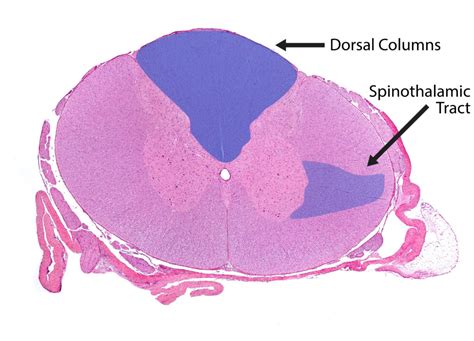 Spinal Cord Stimulation SCS Ainsworth Institute