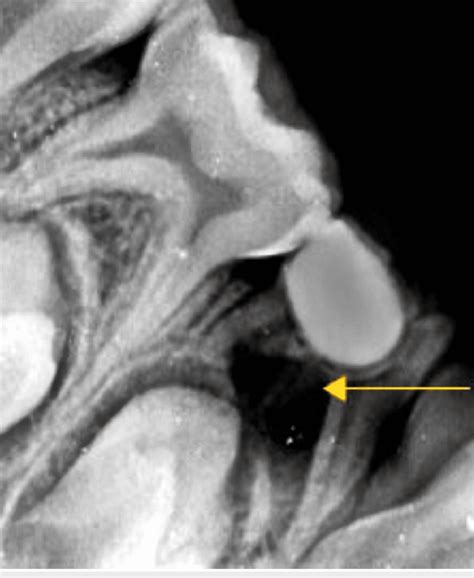 Depiction Of The Radiograph Of Re Of The Left Deciduous Mandibular Download Scientific Diagram