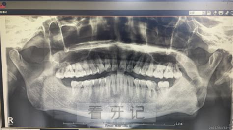 全景片是什么医院为什么要求必须拍全景片 看牙记网