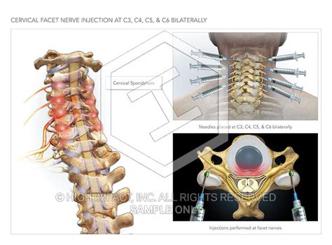Image 09765im01 Cervical Facet Nerve Injection At C3 C4 C5 And C6 Bi