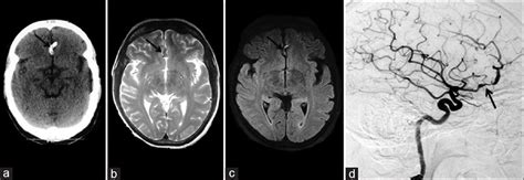 Neurology India