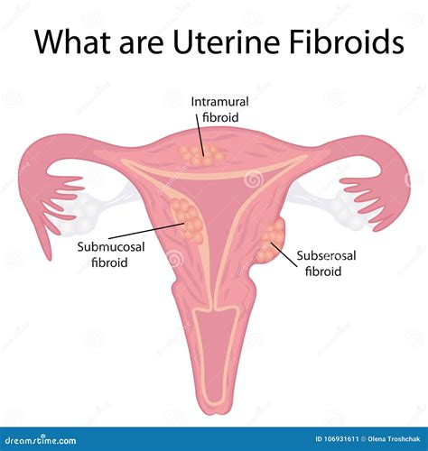 Submucosal Fibroids Endometriosis Infographics Vector Illustration