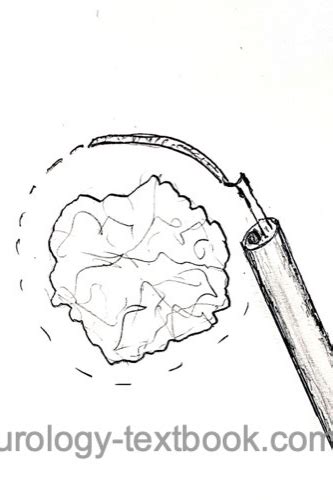 Turb Transurethral Resection Of Bladder Tumor
