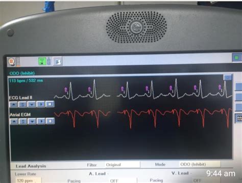 Pacemaker Implantation Archives Trust Multispeciality Hospitals
