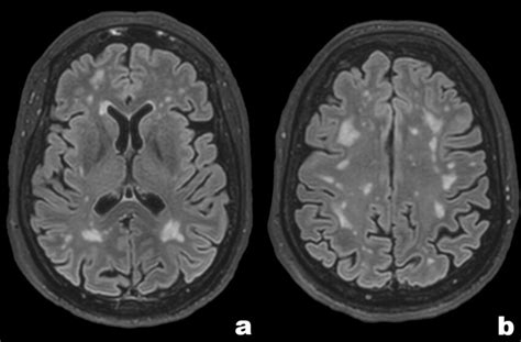 Flair Images Show Confluent Areas Of Leukoencephalopathy In A Patient Download Scientific