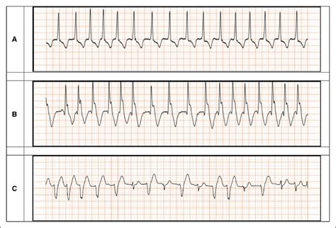 Examples Of Ecg Recordings With Disagreement A Svt Nonshockable