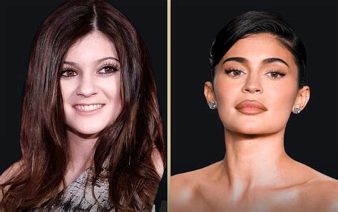 Kylie Jenners Plastic Surgery Journey Before And After