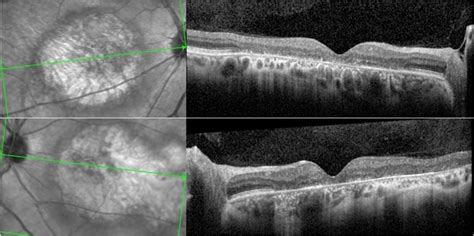 Geographic Atrophy Secondary To Central Areolar Choroidal Dystrophy