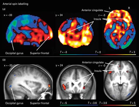 Arterial Spin Labelling Difference Maps Between Thc And Placebo