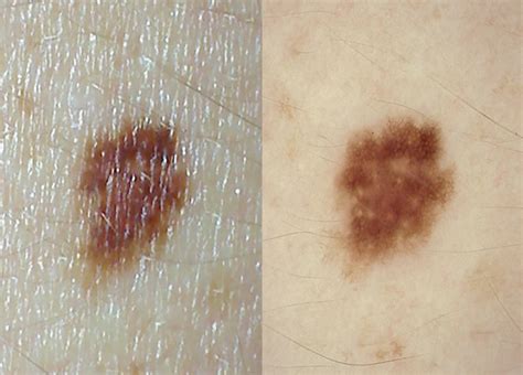 Common Lumps And Bumps On And Under The Skin What Are They Dermatology Research Centre