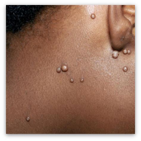 Does Curettage For Molluscum Offer Effective Treatment