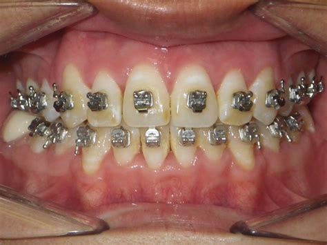 Braces Dr Silvia Menendez Smiles Orthodontics In El Paso Texas