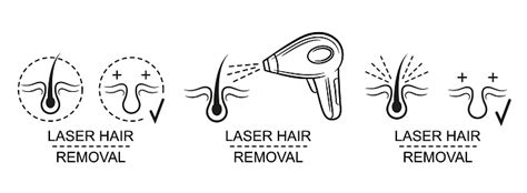 레이저 머리 전구 제거 여자 피부 제모 아름다움 절차 라인 아이콘 탈모 Ipl 빔 제모기 바디 케어 위생 열광선 성장을 멈추고 여포를 제거하십시오 미용 치료 벡터