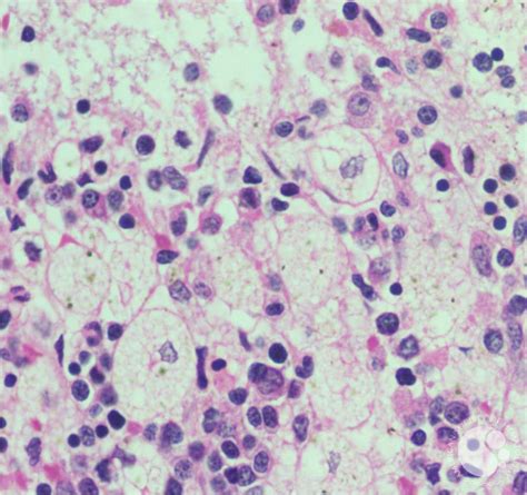 Figure 05 Trephine Biopsy Showing Foamy Macrophages With Abundant