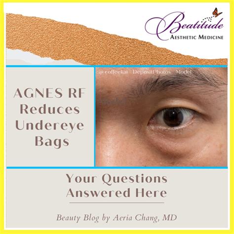 Get Rid Of Under Eye Bags With Agnes Rf Under Eye Bags Eye Bags Aesthetic Medicine