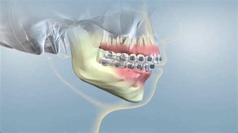 Having Orthognathic Surgery Class 2 On Vimeo
