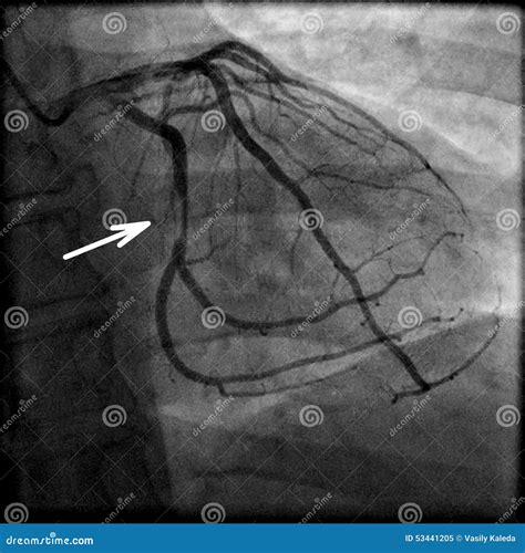 Coronary Artery Stenosis On Angiography Stock Image Image Of Graft Arrow 53441205