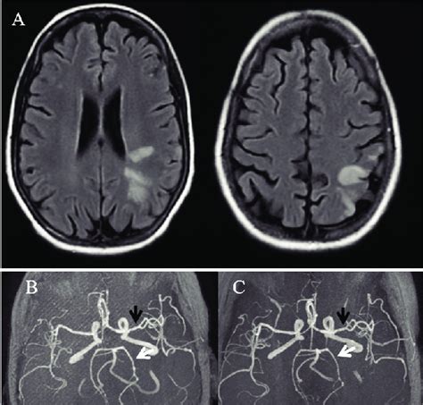 A Mri In T2 Flair Sequence Shows Multiple Ischemic Lesions In