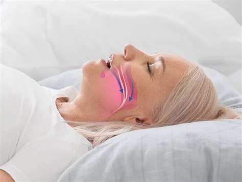 Sleep Apnea Doctor Madison Ridgeland Jackson Ms