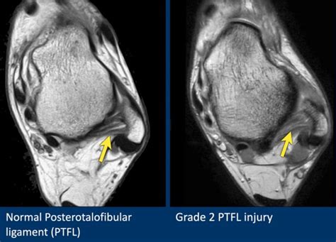 Calcaneofibular Ligament Mri Magnetic Resonance Imaging Of Ankle