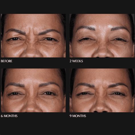 Daxxify New Medical Spa