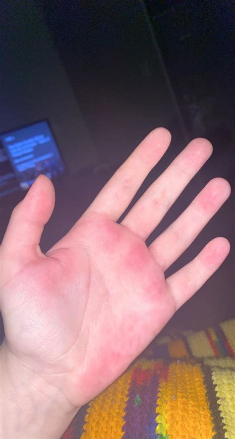 I Think I Have Em R Erythromelalgia