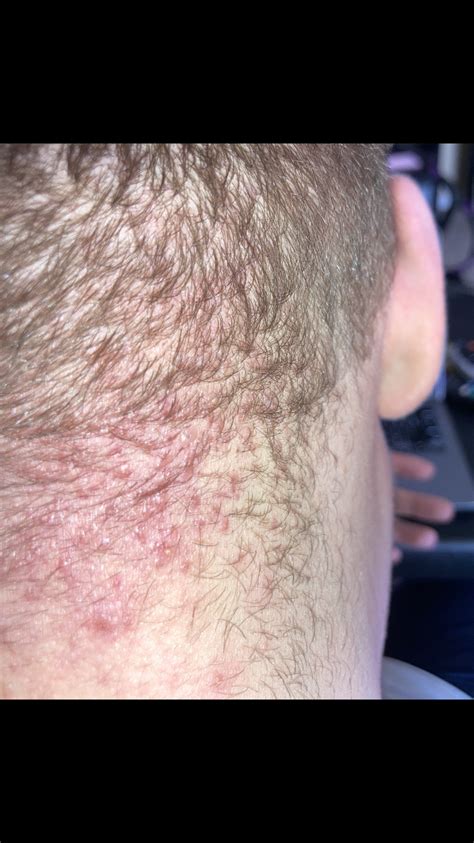 Diet And Other Questions Severe Scalp Folliculitis For 2 Years Folliculitis