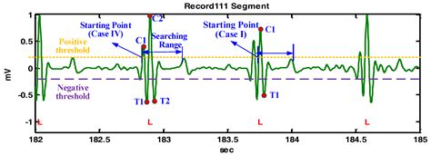 A Qrs Detection And R Point Recognition Method For Wearable Single Lead