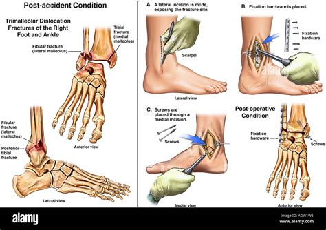 Lateral Malleolus Anatomy