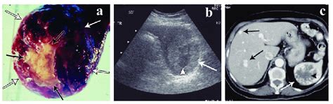 Angiosarcoma Of The Spleen Source W M Thomson Angiosarcoma Of The Download Scientific