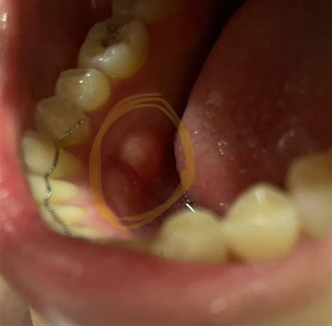 아래 안쪽 잇몸 지식in