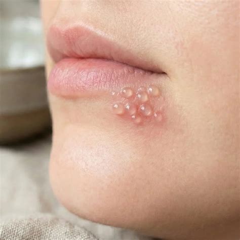 What Does Herpes Look Like 5 Stages And Fast Cure — Doctor2me