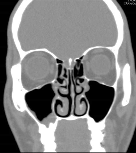 Sinus Ct Scan Report Sinus Resources Maxillary Sinus