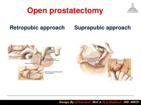 Suprapubic Prostatectomy Prostate Cancer Surgery Prostatectomy