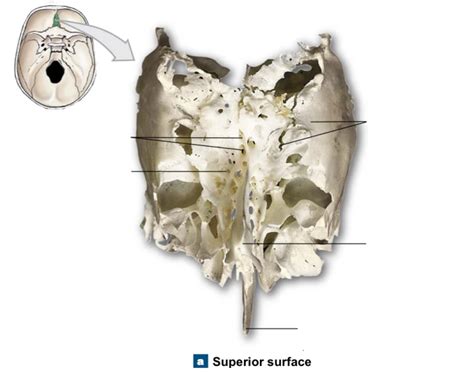 Superior Surface Of Ethmoid Quiz