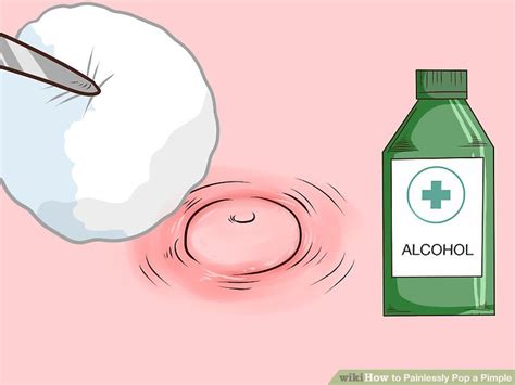 3 Ways To Painlessly Pop A Pimple WikiHow