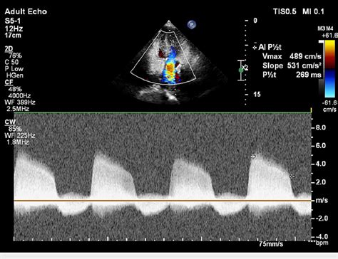 Continuous Wave Doppler Aortic Valve