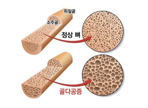 골다공증 영종튼튼신경외과 의원