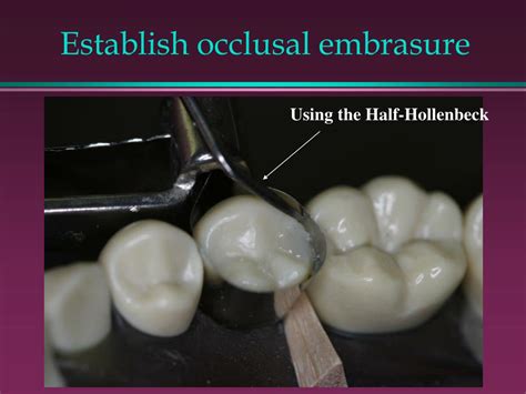 Ppt Class I And Ii Composite Restorations Principles And Techniques Powerpoint Presentation Id